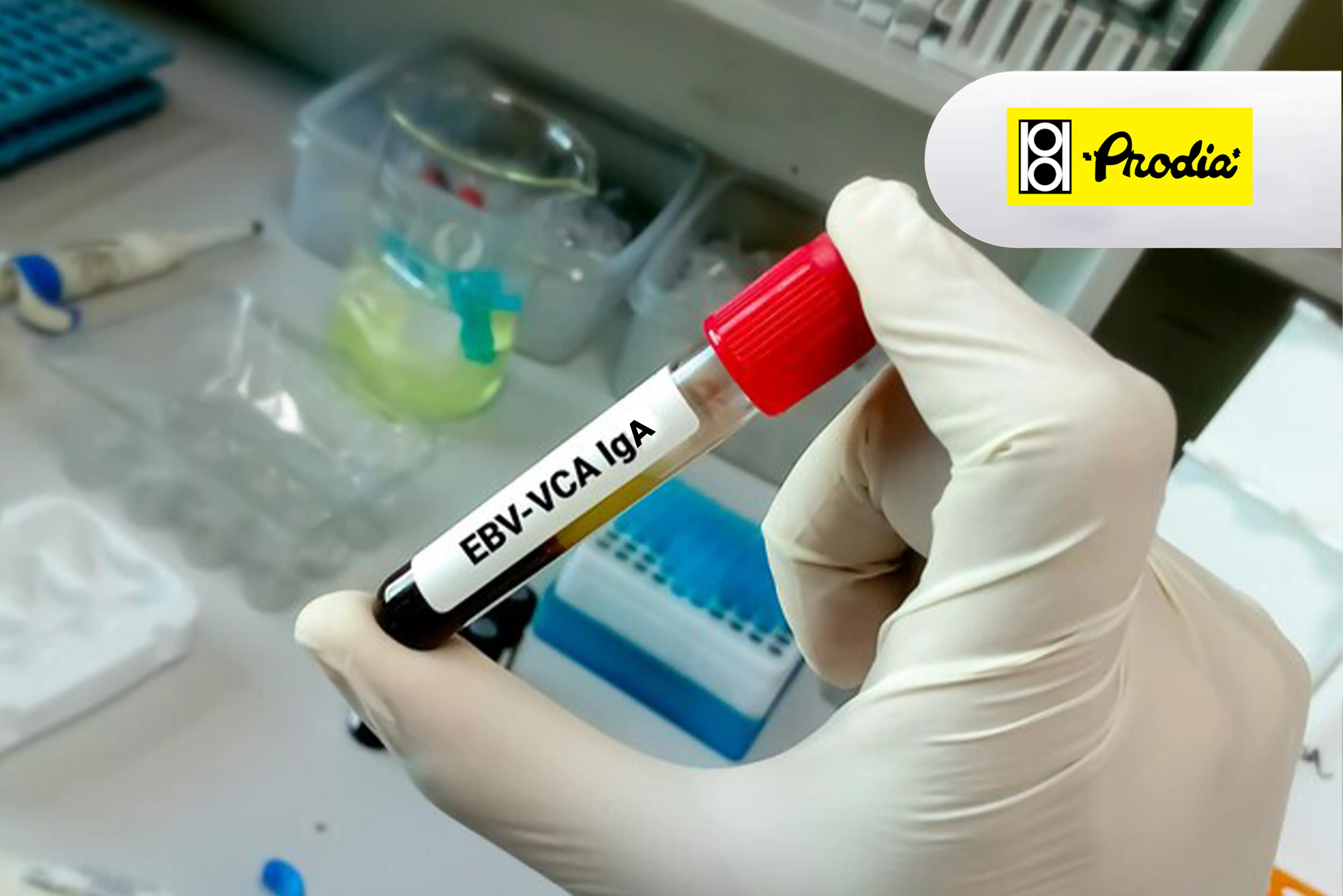 Pesan Layanan Epstein-Barr Virus Viral Capsid Antigen (VCA) Antibody ...